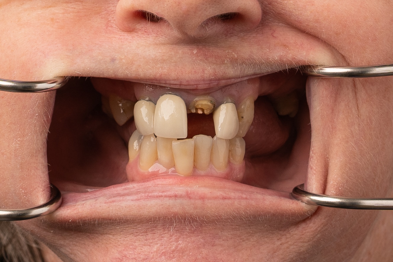 Before & After All-On-4 Dental Implants | Real Photos of Patients