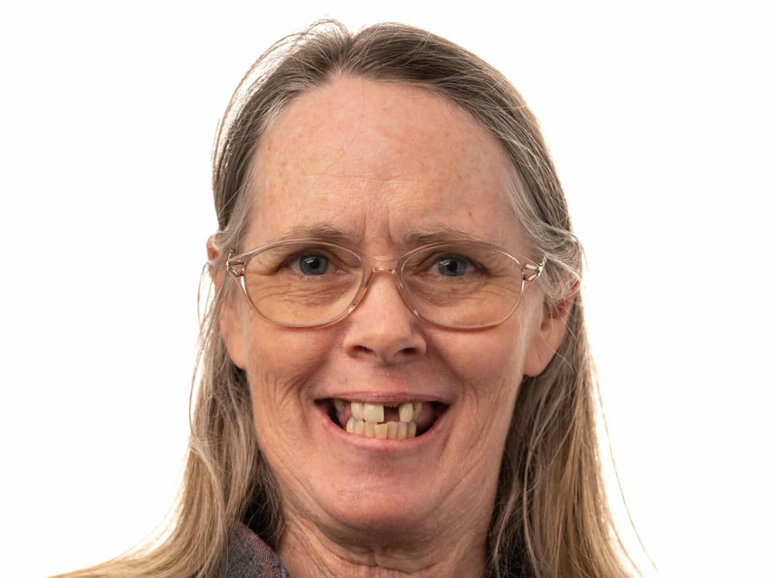 Before & After All-On-4 Dental Implants | Real Photos of Patients