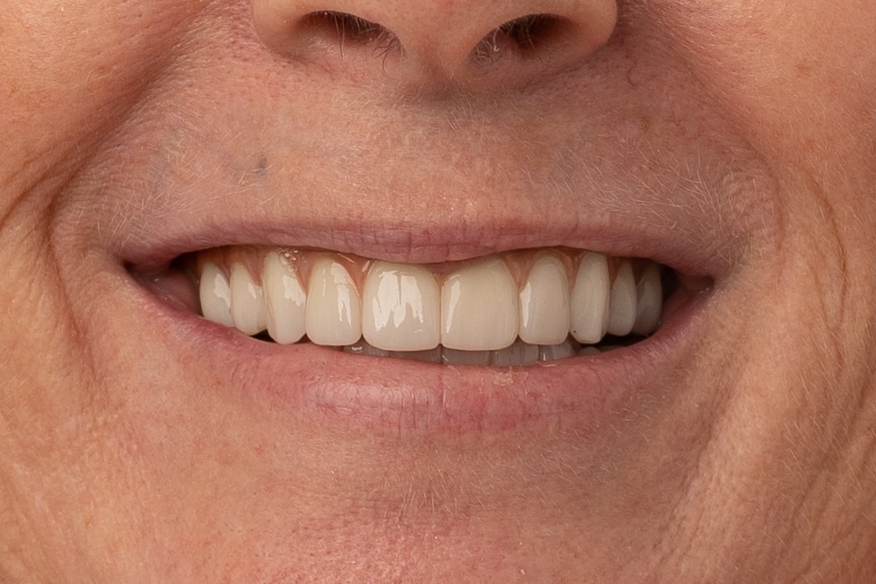 Before & After All-On-4 Dental Implants | Real Photos of Patients